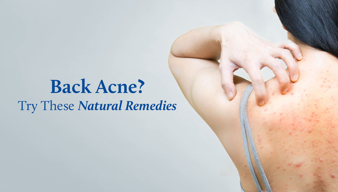 The Most Effective Home Remedies for Back Acne treatment. – Blue Nectar